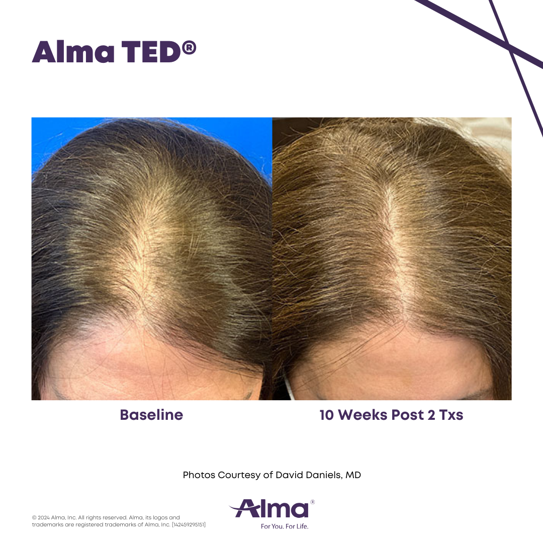 Alma Ted - Hair Restoration Treatment - Berkowitz Dermatology