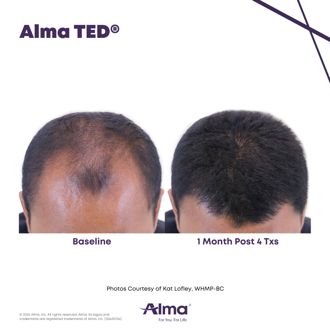 Alma Ted - Hair Restoration Treatment - Berkowitz Dermatology